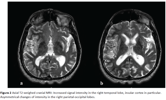Prolonged Todd Paralysis: A Rare Case of Postictal Motor Phenomenon ...